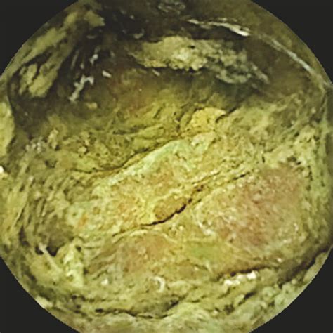 Noninvasive Visualization Of Neutropenic Enterocolitis Using Capsule