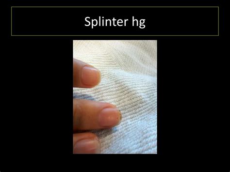 Ppt Infective Endocarditis Powerpoint Presentation Free Download