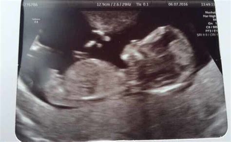 12 Week Scandating Scan