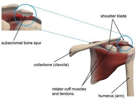 Subacromial Impingement Treatment Afbua
