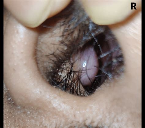 Are These Nasal Polyps R Nasalpolyps