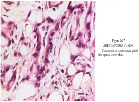 Pathology Outlines Adenomatoid Tumor