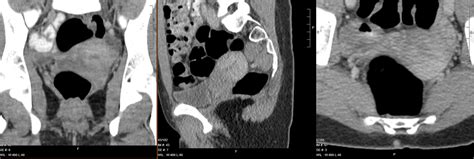Was Trying To See If I Could Find My Retrocecal Appendix On My Old Er Was Trying To See If I Could Find My Retrocecal Appendix On My Old Er