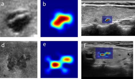 The Cams Of Thyroid Nodules A A Benign Thyroid Nodule B The Download Scientific Diagram