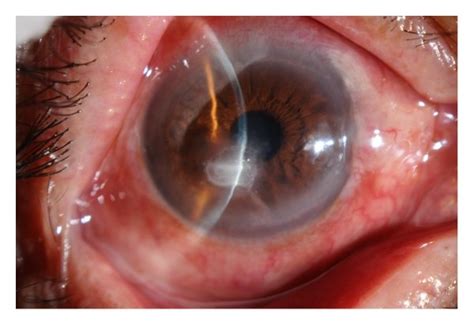 A Fungal Keratitis With Hypopyon B Seven Days After Antifungal Download Scientific Diagram