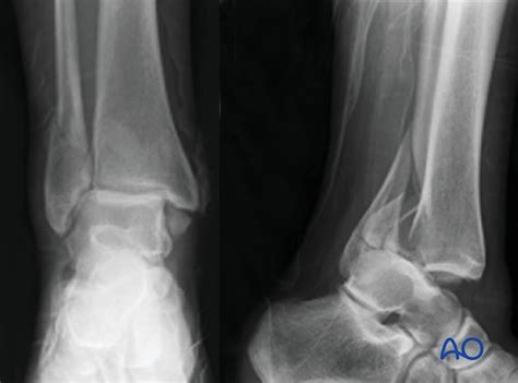 Transsyndesmotic Posterior Lateral Multifragmentary And Medial Fractures