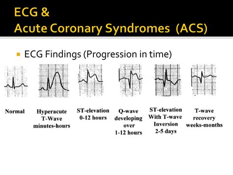 Ppt Ecg And Cardiac Arrest Powerpoint Presentation Free Download Id