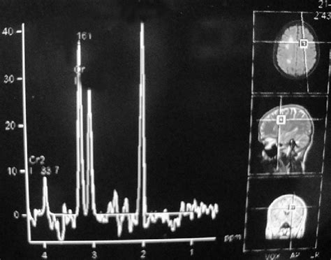 Magnetic Resonance Spectroscopy Single Voxel At 135 Ms Showing A Download Scientific Diagram