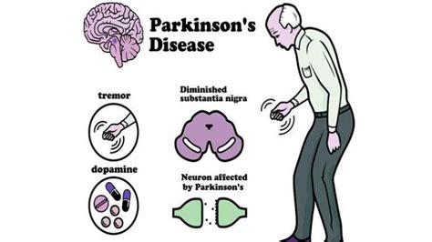 10 Early Signs Of Parkinsons Disease Entirely Health