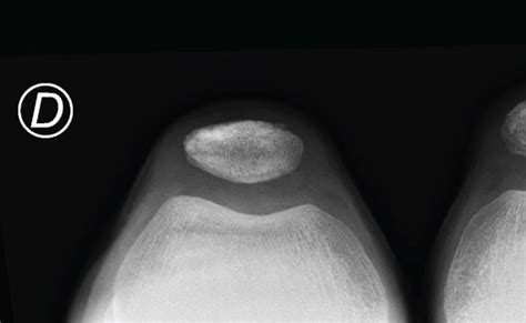 X Ray 3 Axial View Of Both Knees Right Knee On The Left Initial