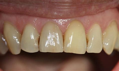 Cosmetic Dentist Manassas Va Internal Bleaching Gallery