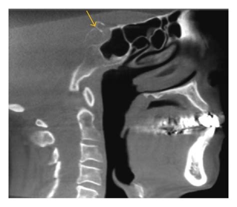 A Sagittal View Demonstrates Intracranial Vascular Calcification