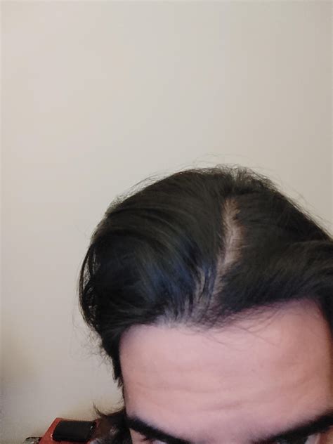 Am I Thinning Balding R Malehairadvice