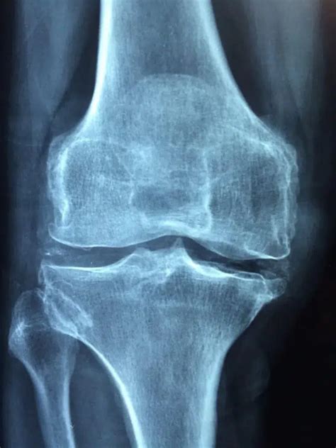 Most Common Broken Bones The Compensation Experts