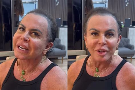 Gretchen Comemora Resultado De Tratamento De Alopecia E Médica Comenta