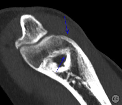 What Is A Shear Fracture Definition At Lavon Sotelo Blog