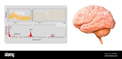 Intracranial Pressure Monitoring Icp Waveform 3d Render 2d Graphic
