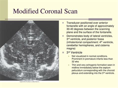Ppt Neonatal Echoencephalography Powerpoint Presentation Free
