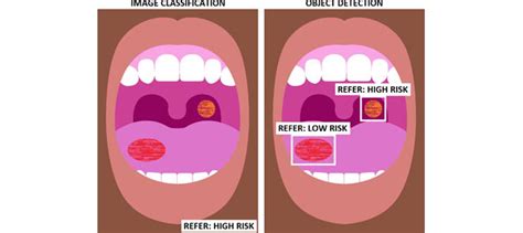 Automated Detection And Classification Of Oral Lesions Using Deep Learning For Early Detection