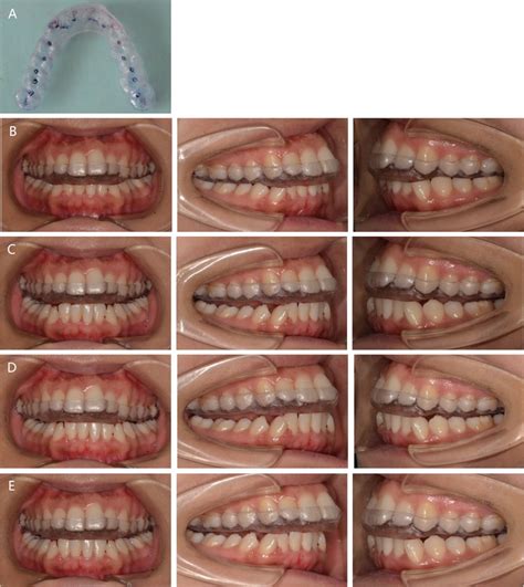 Diagnostic And Treatment Protocol For A Patient With Temporomandibular
