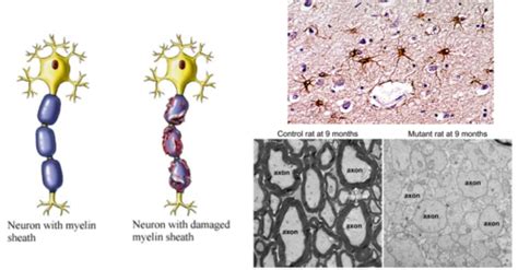 Neurodegeneration In Multiple Sclerosis Flashcards Quizlet