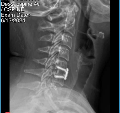 3 Weeks Post Op 1 Level Acdf Rspinalfusion