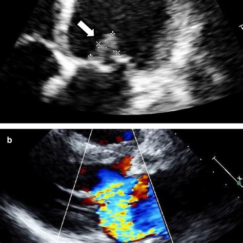 Streptococcus Pyogenes Endocarditis And Serotypesemm Types Download Table