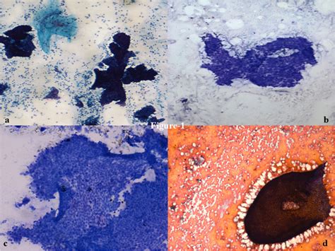 Fibroadenoma Versus Phyllodes Tumor A Vexing Problem Revisited Pmc