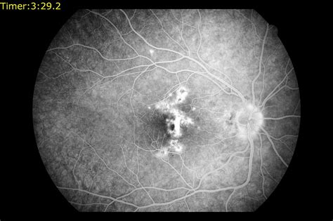 Butterfly Shaped Pattern Dystrophy