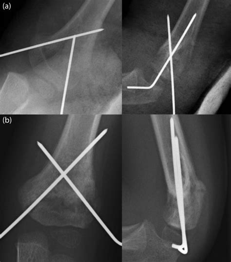 Postponing Surgery Of Paediatric Supracondylar Humerus Fractures To Office Hours Increases