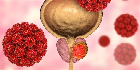 Blaaskanker Lees Er Hier Alles Over Leestip