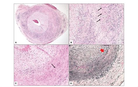 A The Histopathological Appearance Of A Temporal Artery With Narrowed Download Scientific