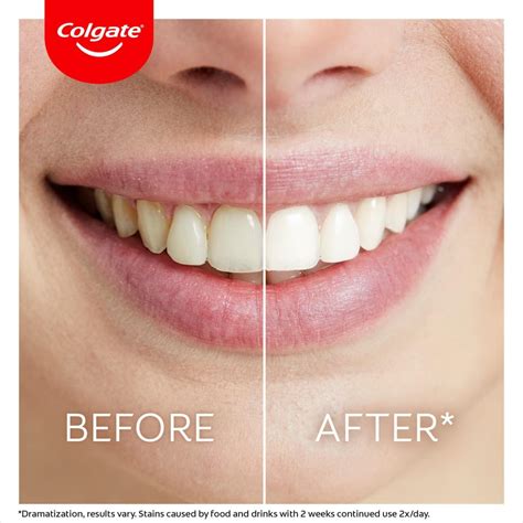 Colgate Max White Ultimate Led Teeth Whitening Kit Enamel Safe Up