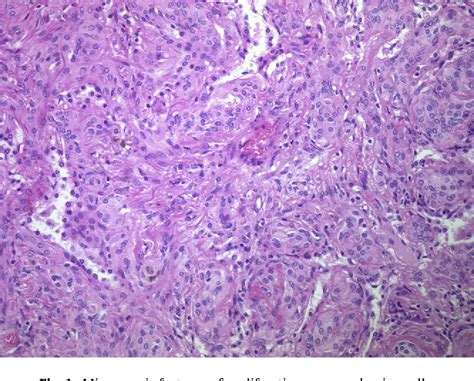 Figure 1 From Association Of Small Foci Of Diffuse Idiopathic Pulmonary