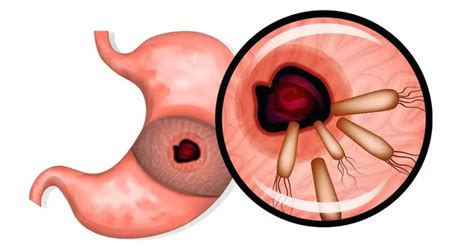 幽门螺杆菌无创检测市场和临床试验要点分析 知乎