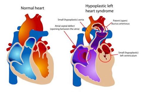 13 Best Shones Complex Images On Pinterest Asd Cardiovascular