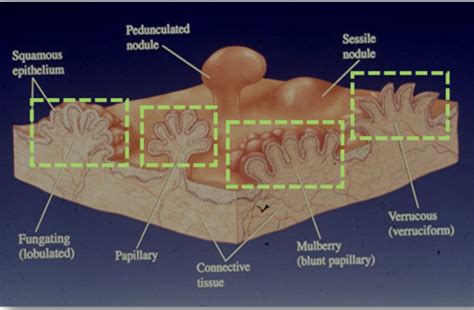 Oral Diseases Epithelial Pathology Flashcards Quizlet