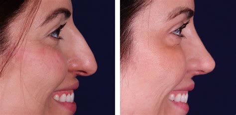 Deviated Septum Before And After Septoplasty 101 Cost Recovery