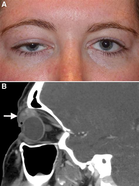 Primary Synovial Sarcoma Of The Orbit A Case Report And Upd