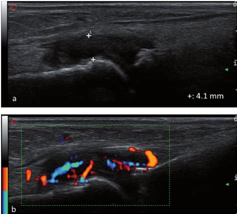 Synovitis Of The Mtp Joint 2 At Dorsal Aspect In Grey Scale Ultrasound