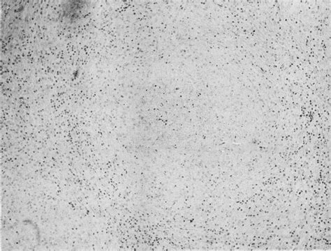 Caseating Epithelioid Cell Granuloma In The Mesenteric Mass Download Scientific Diagram