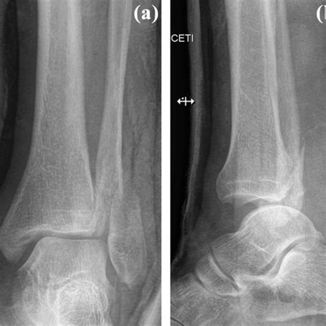 Ct Imaging Demonstrated Posterior Displacement Of The Proximal Fibular