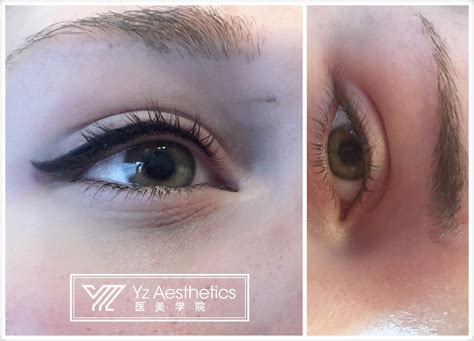 Eyeliner Treatments Yz Aesthetics 医美学院