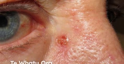 Nodular Basal Cell Carcinoma Image