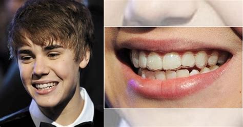Invisalign Celebrities Before And After