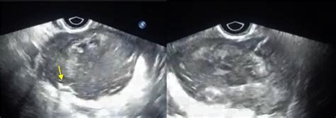 A Complex Mass With Internal Echo In The Cystic Component And Air