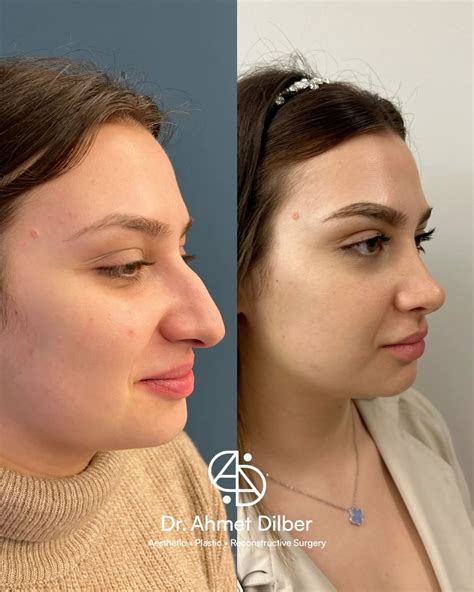 Patient 22397932 Dorsal Hump Before And After Ranch Coast Plastic