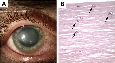 1a At Presentation Exam Showed 360° Of Ciliary Flush And A 5 × 6 Mm Download Scientific