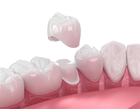 When Is Crown Or Cuspal Coverage Necessary After Root Canal Treatment