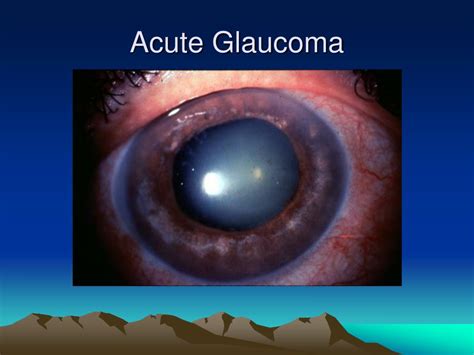 Ppt Glaucoma Powerpoint Presentation Free Download Id230118